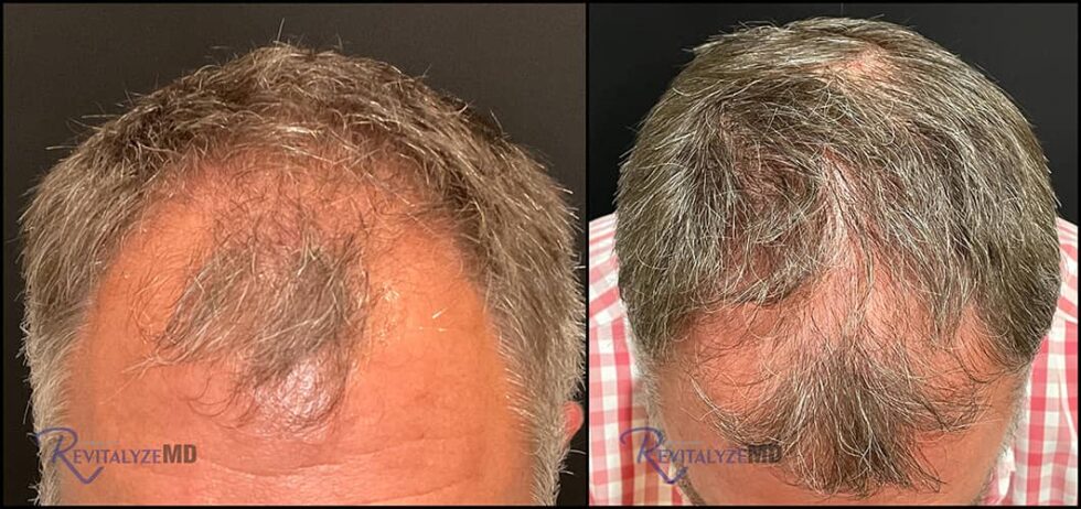 Rejuvenating Your Hair: The Science Behind PRF Hair Restoration